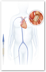 Medtronic's Melody Pulmonary Heart Valve Approved by FDA ...
